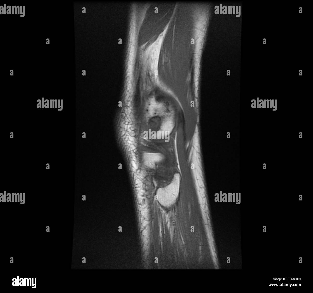 Negative X ray image of human Knee Rheumatism Stock Photo - Alamy