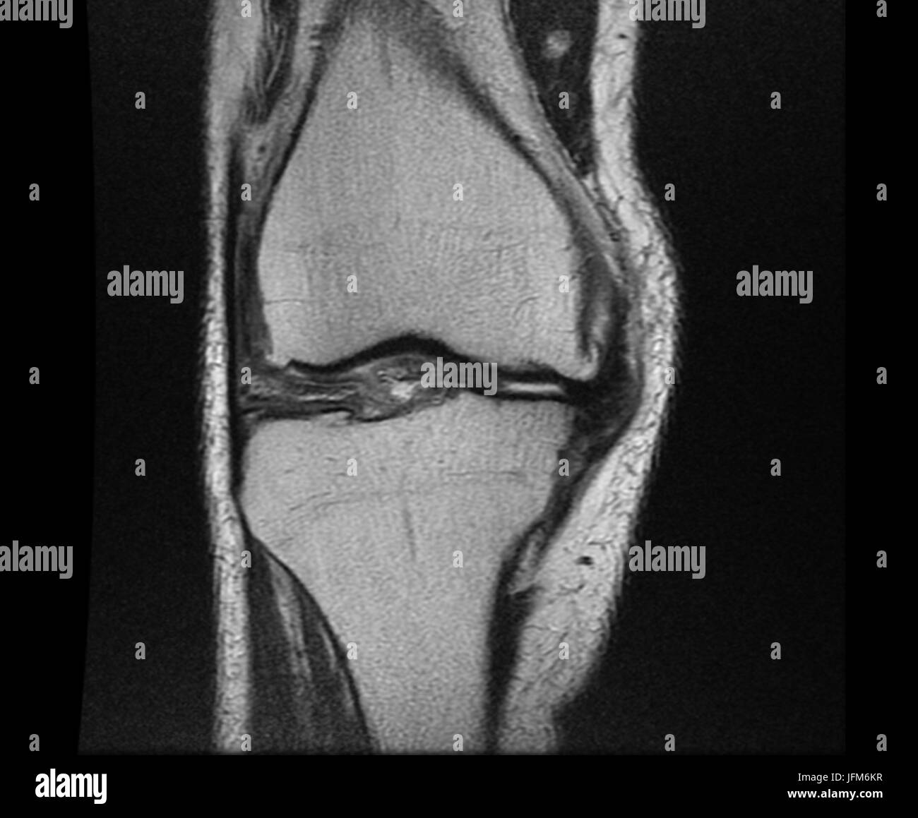Negative X ray image of human Knee Rheumatism Stock Photo - Alamy
