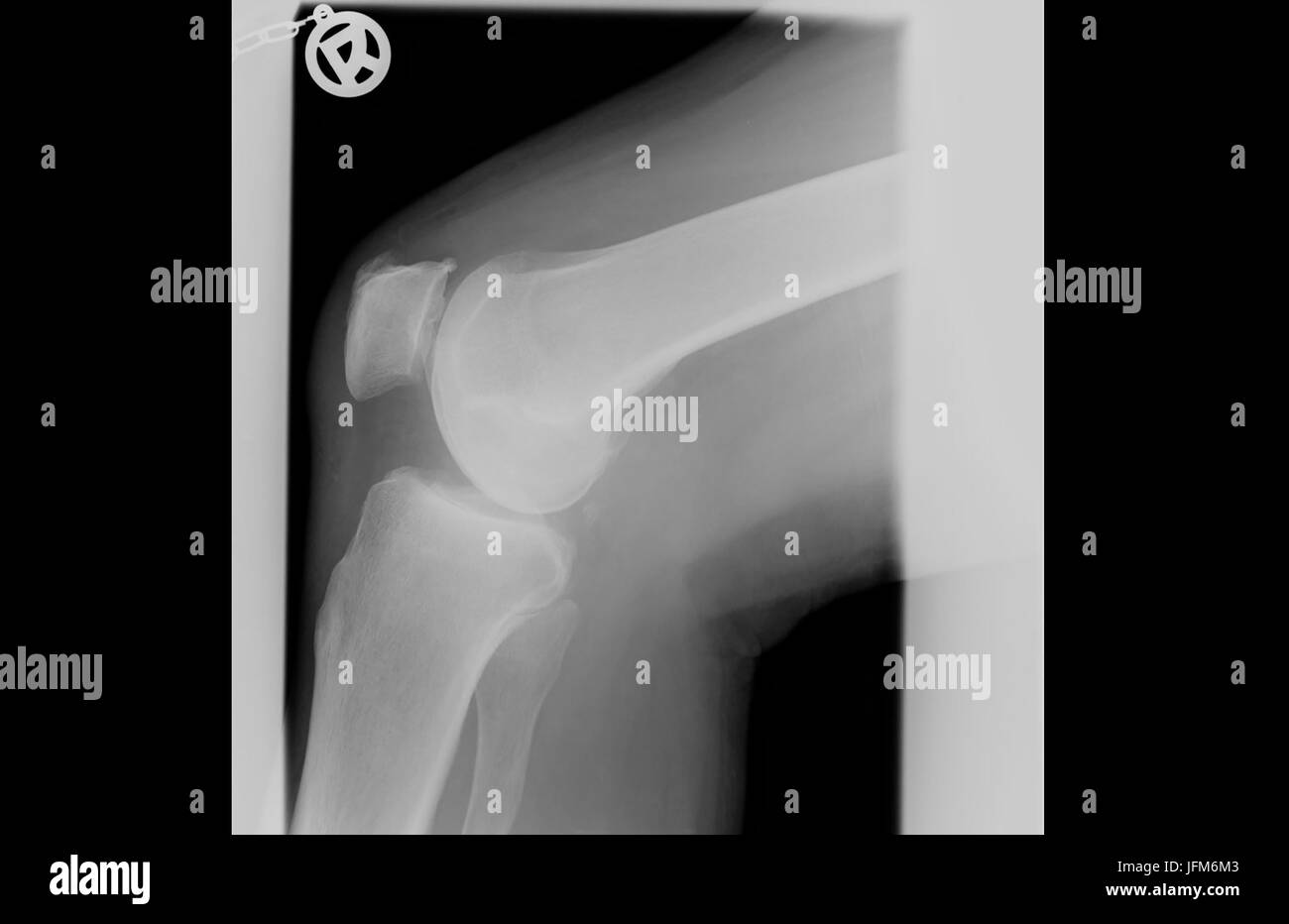 Negative X ray image of human Knee Rheumatism Stock Photo - Alamy