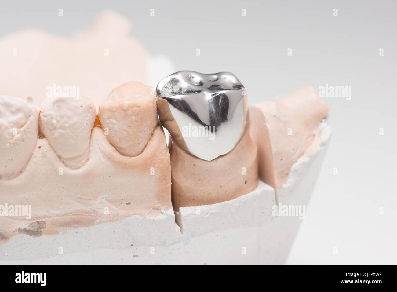 Steel artificial dental crown for dentition restoration Stock Photo - Alamy