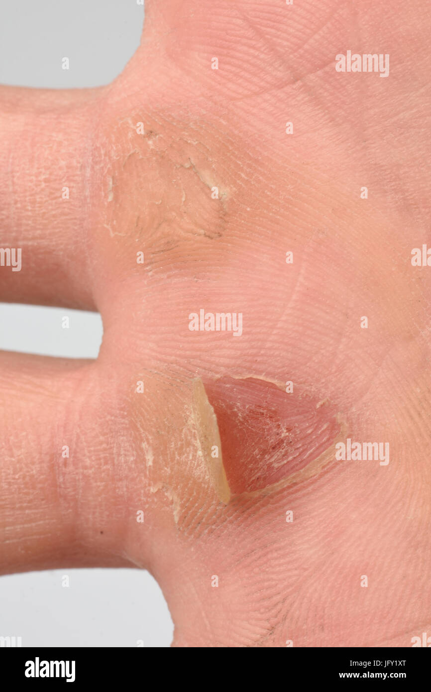 Work calluses hi-res stock photography and images - Alamy
