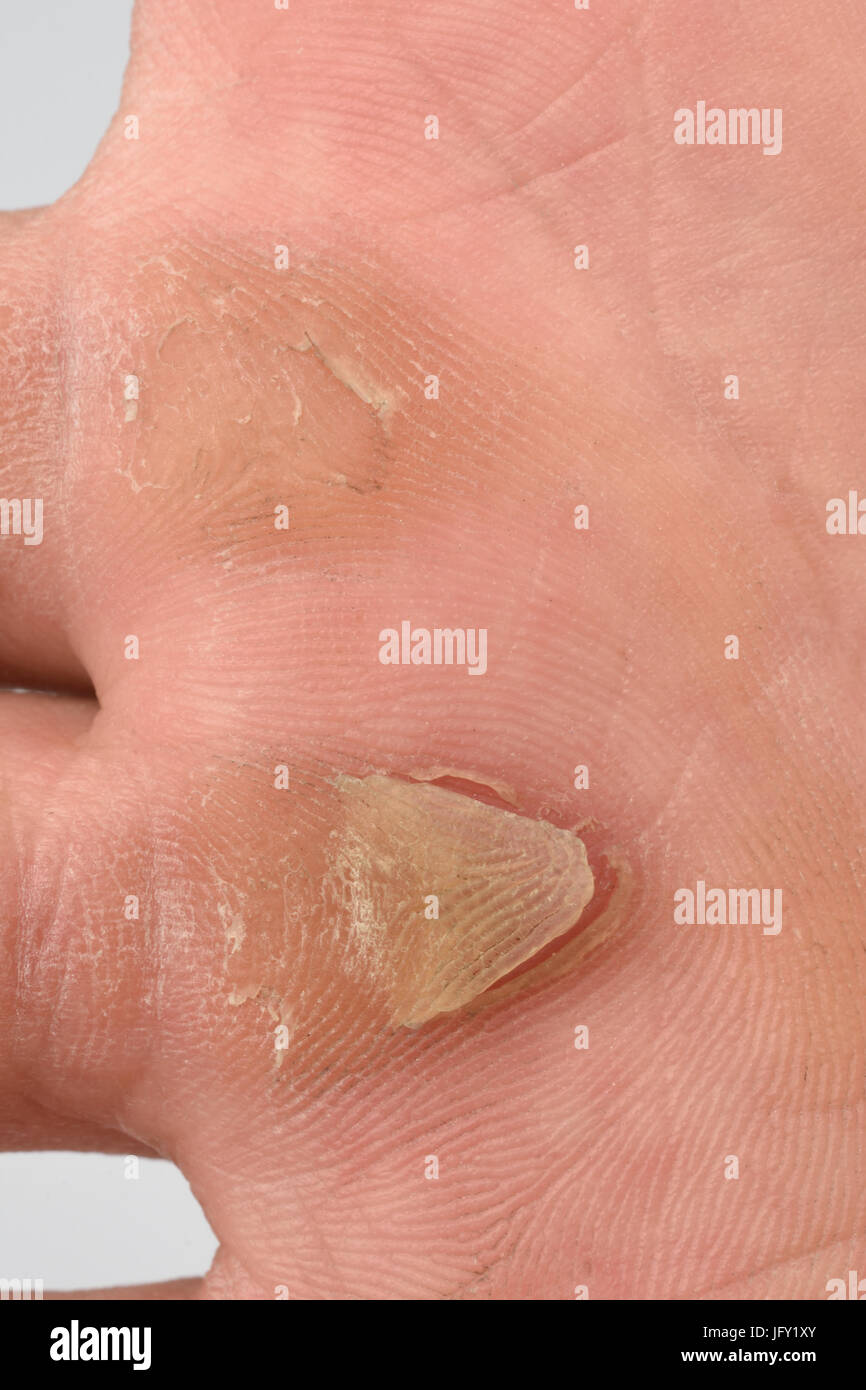 detail of calluses on the palm Stock Photo - Alamy