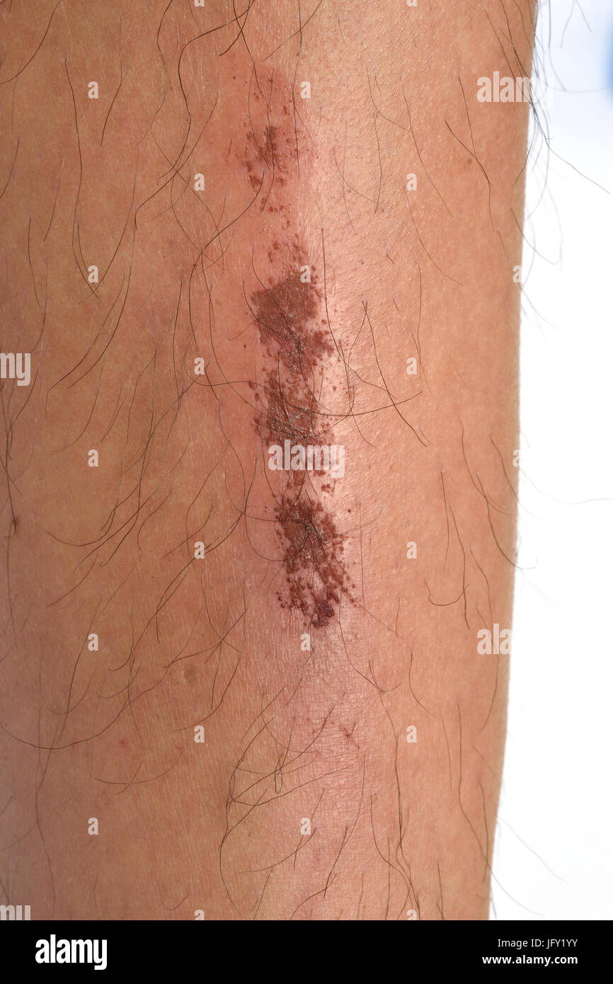 Man leg painful red hi-res stock photography and images - Alamy