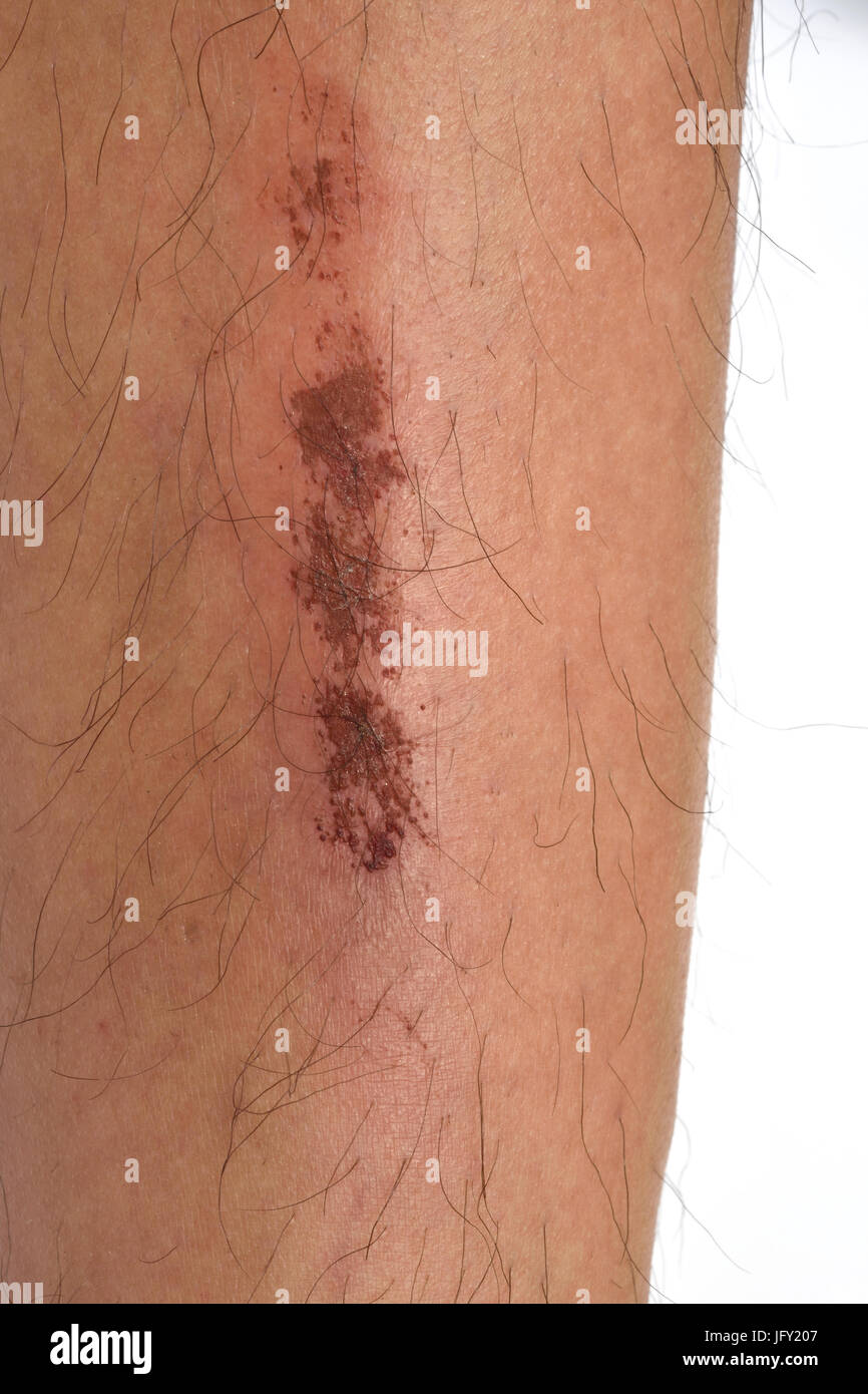 Human scab hi-res stock photography and images - Alamy