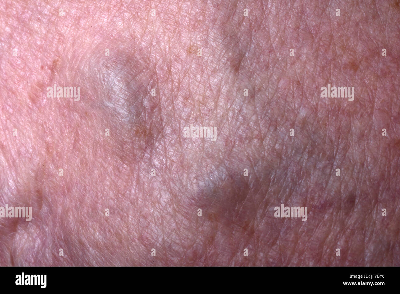 Detail of varicose veins Stock Photo - Alamy