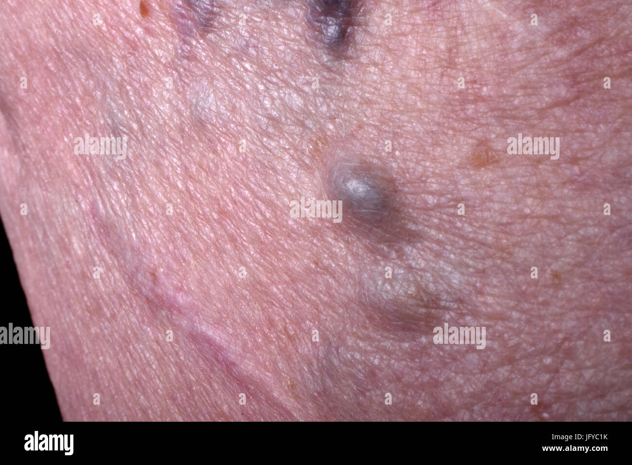 Detail of varicose veins Stock Photo - Alamy