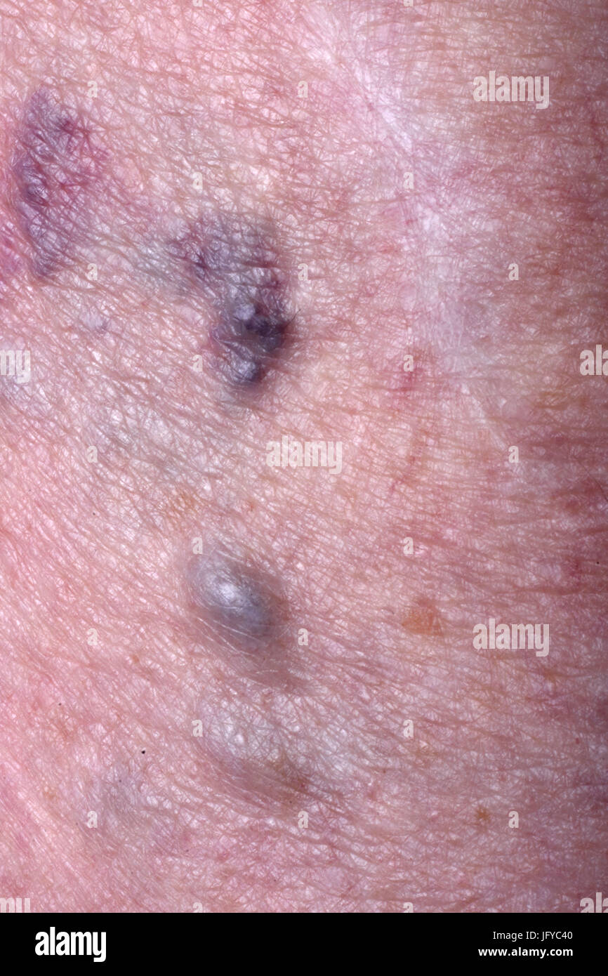 Detail of varicose veins Stock Photo - Alamy