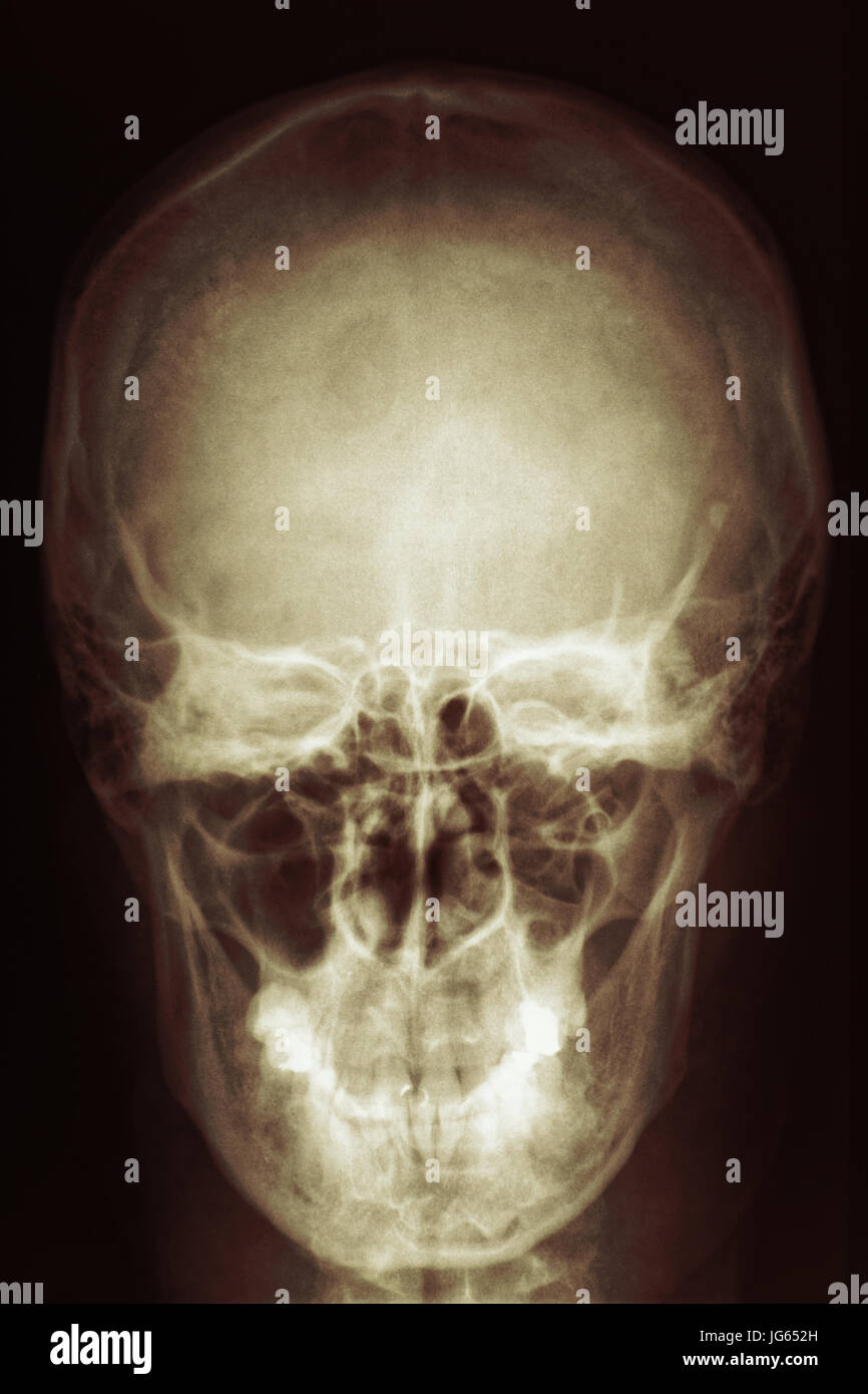 Front skull x ray image hi-res stock photography and images - Alamy