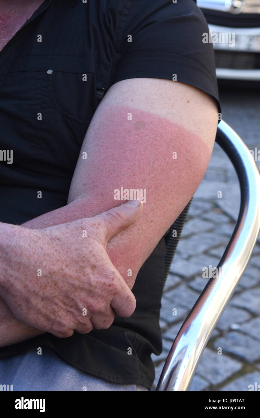 Sun burn arm hi-res stock photography and images - Alamy