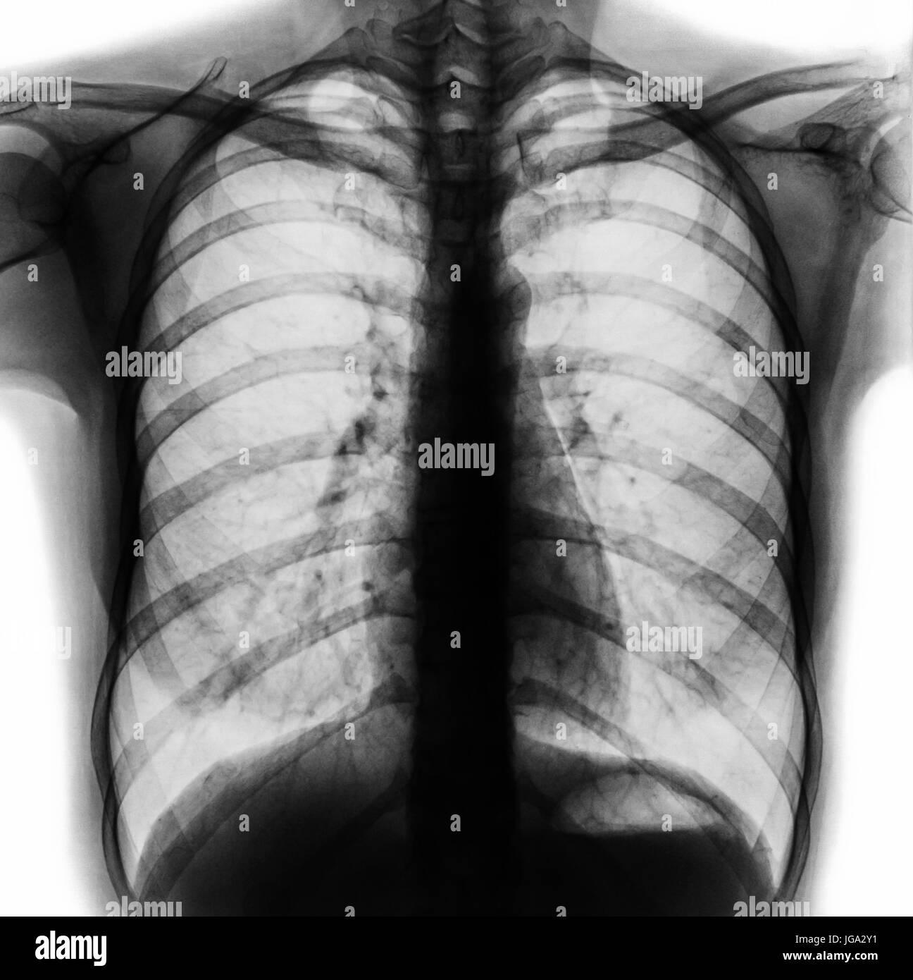 Film chest x-ray PA upright show normal human chest Stock Photo - Alamy