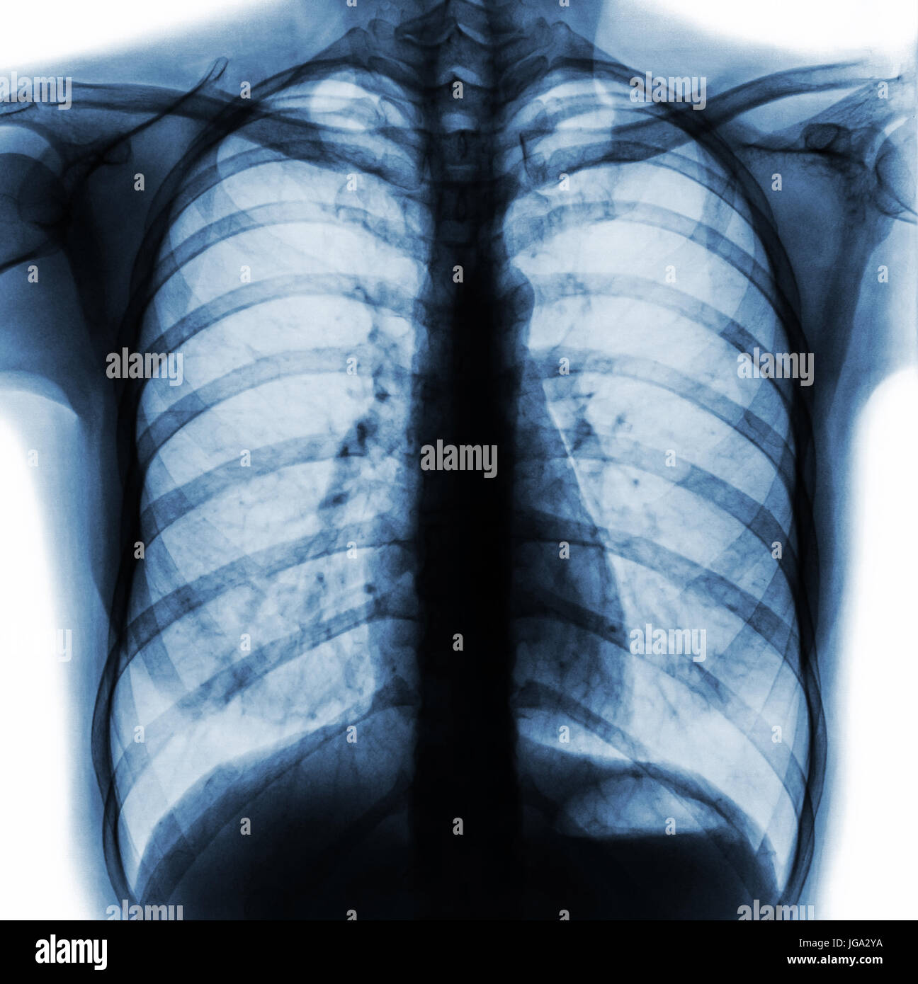 Film chest x-ray PA upright show normal human chest Stock Photo - Alamy
