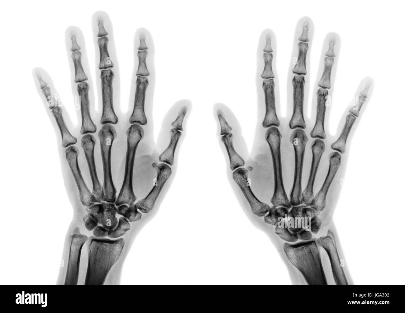 Film x-ray both hand AP show normal human hands on white background ...