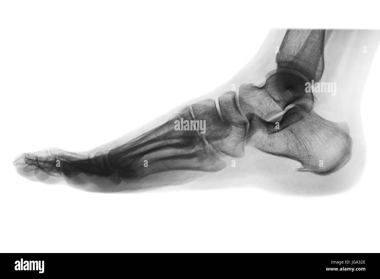 X-ray normal human foot . Lateral view . Invert color style Stock Photo ...