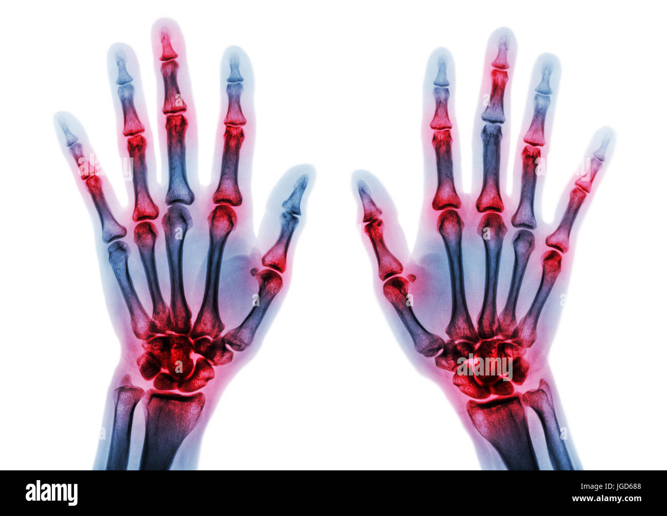 Rheumatoid Arthritis Hands X Ray High Resolution Stock Photography and ...