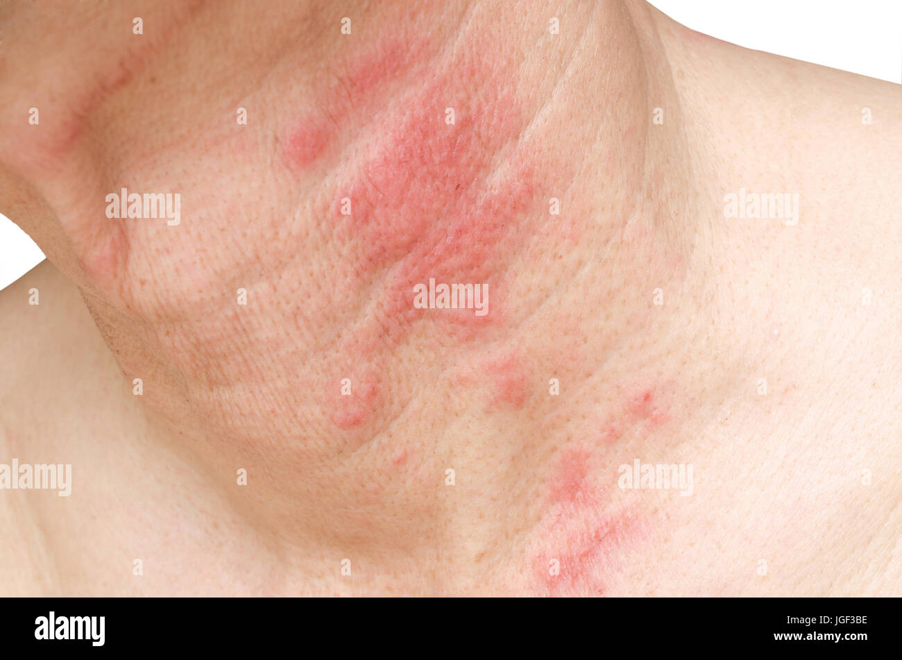 Skin inflammation with ulcer caused by insect bite. Image isolated on ...