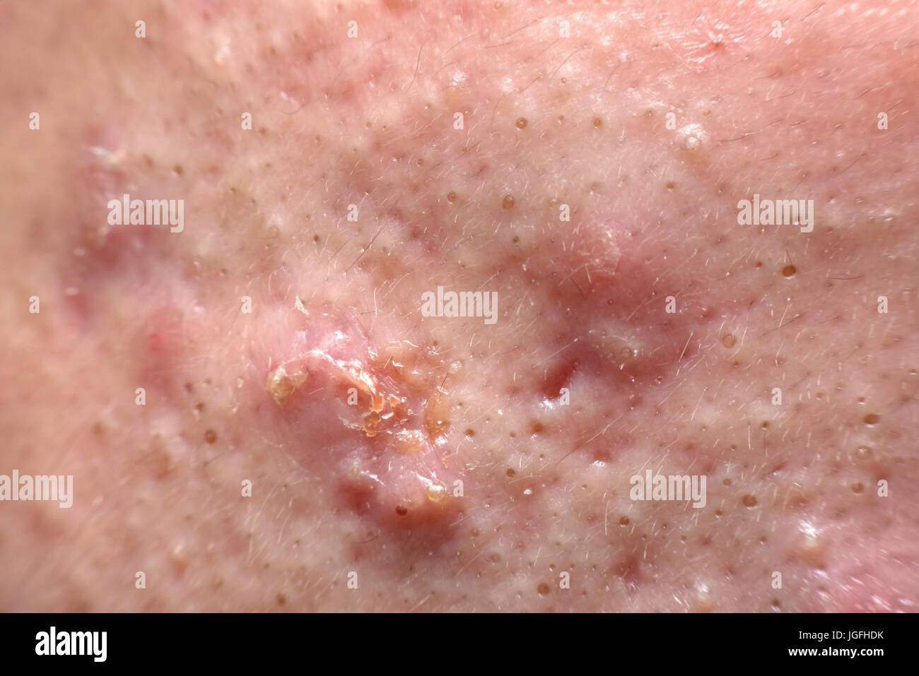 Acne hi-res stock photography and images - Alamy