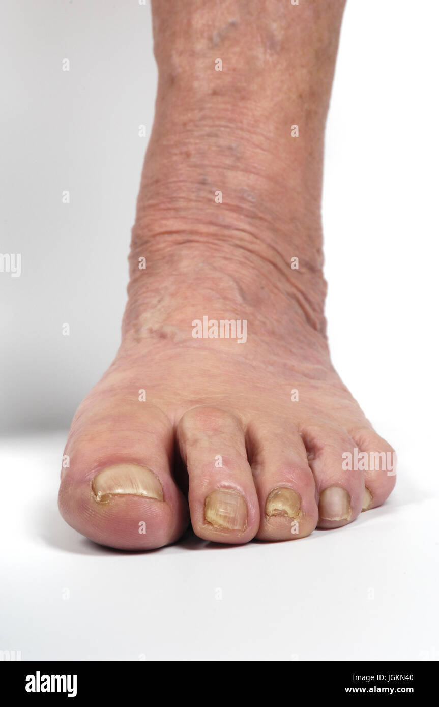 senior woman foot Stock Photo - Alamy