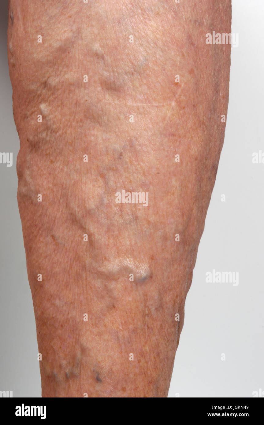 varicose veins in the leg of a woman Stock Photo - Alamy
