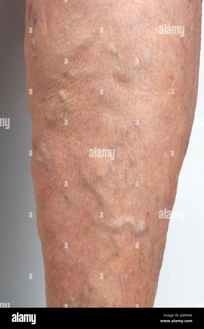 Old woman with varicose veins hi-res stock photography and images - Alamy