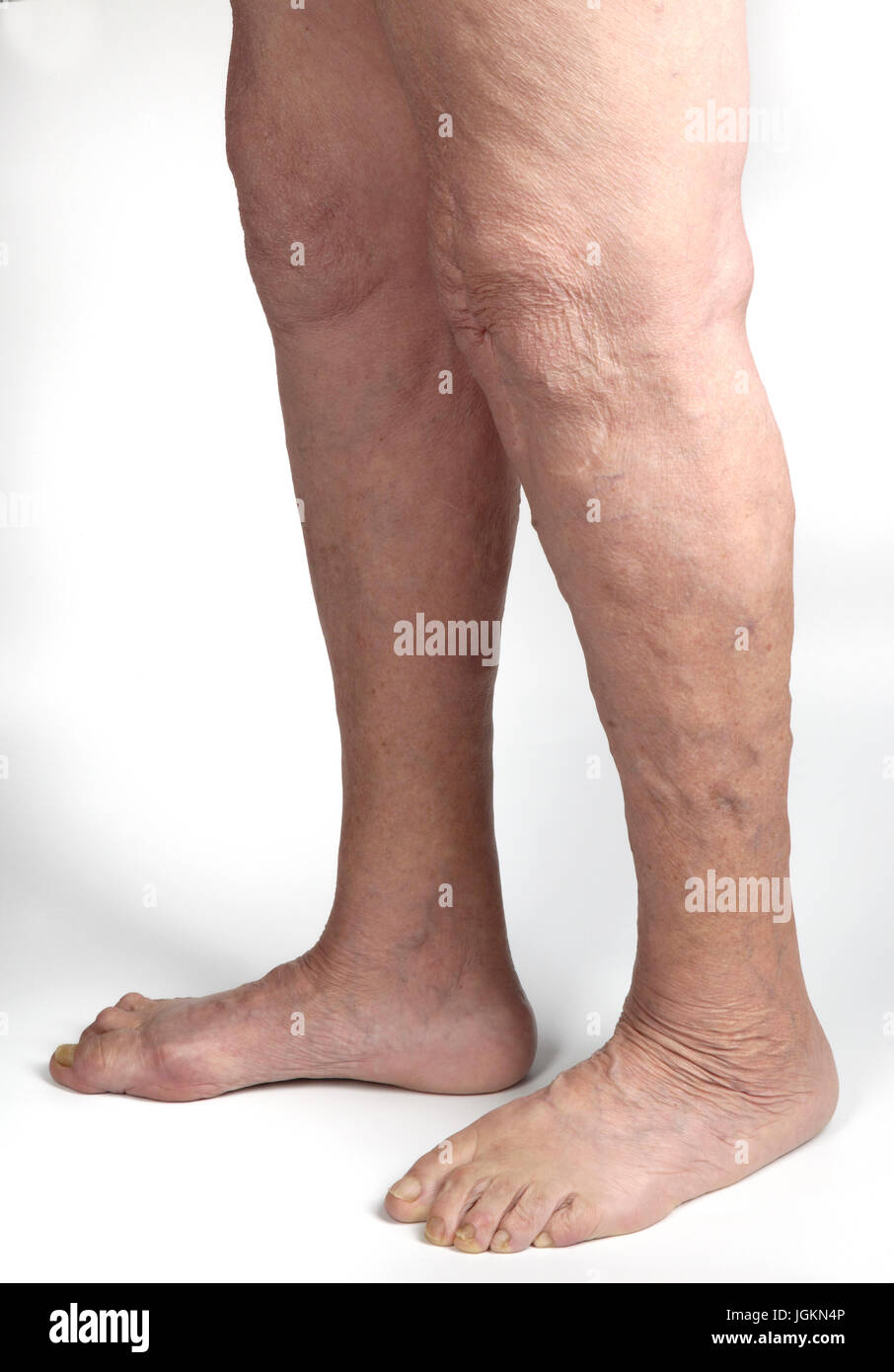senior woman leg Stock Photo - Alamy