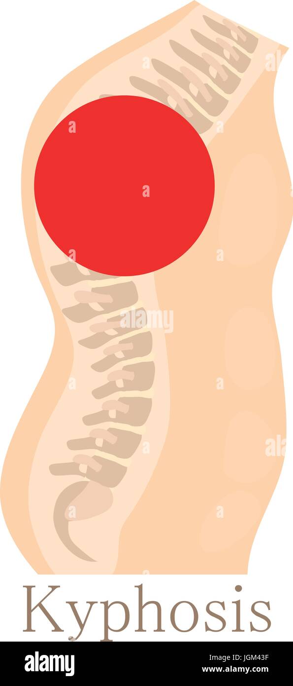 Kyphosis icon, cartoon style Stock Vector Image & Art - Alamy