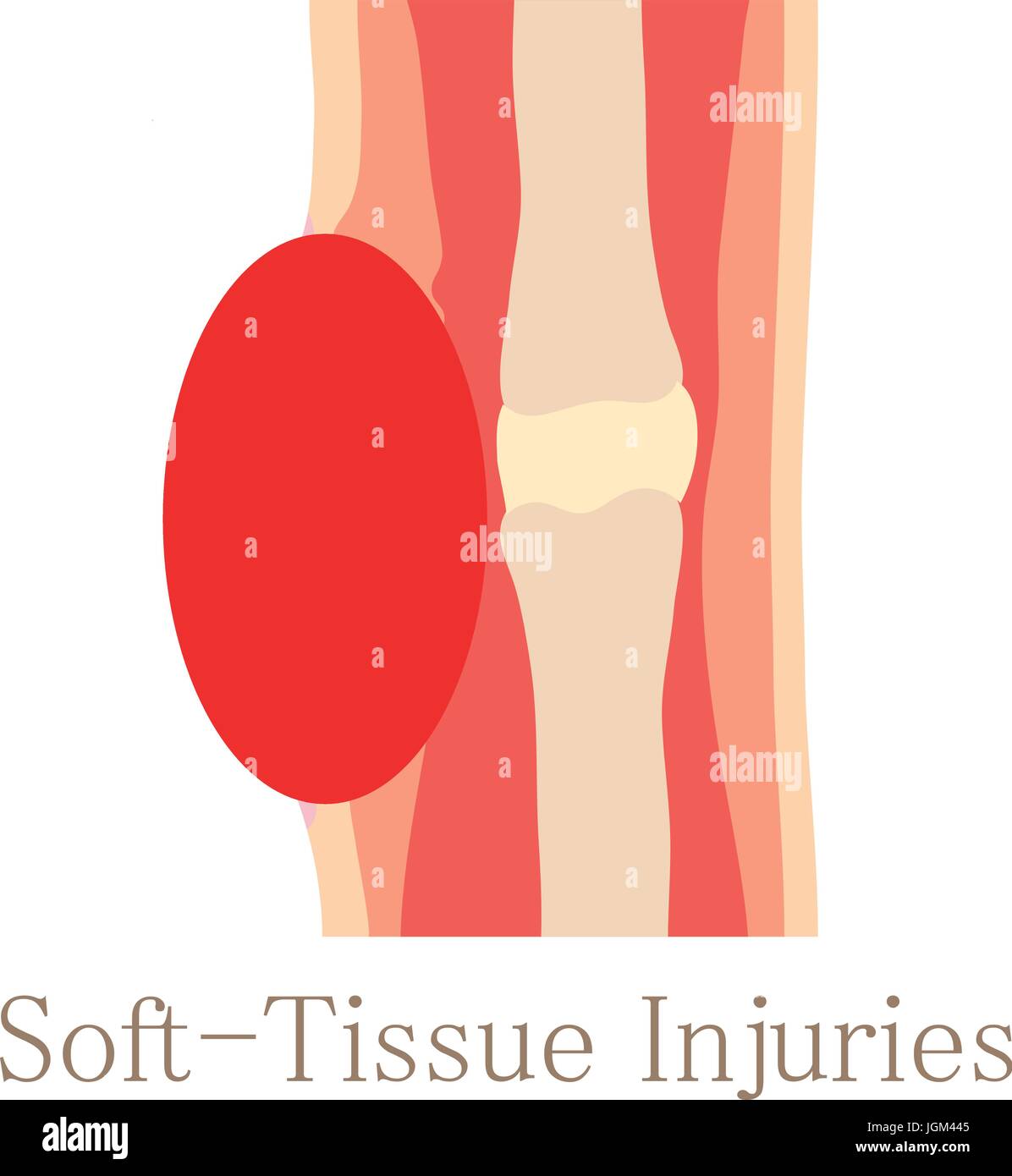 Soft tissue injury Stock Vector Images - Alamy
