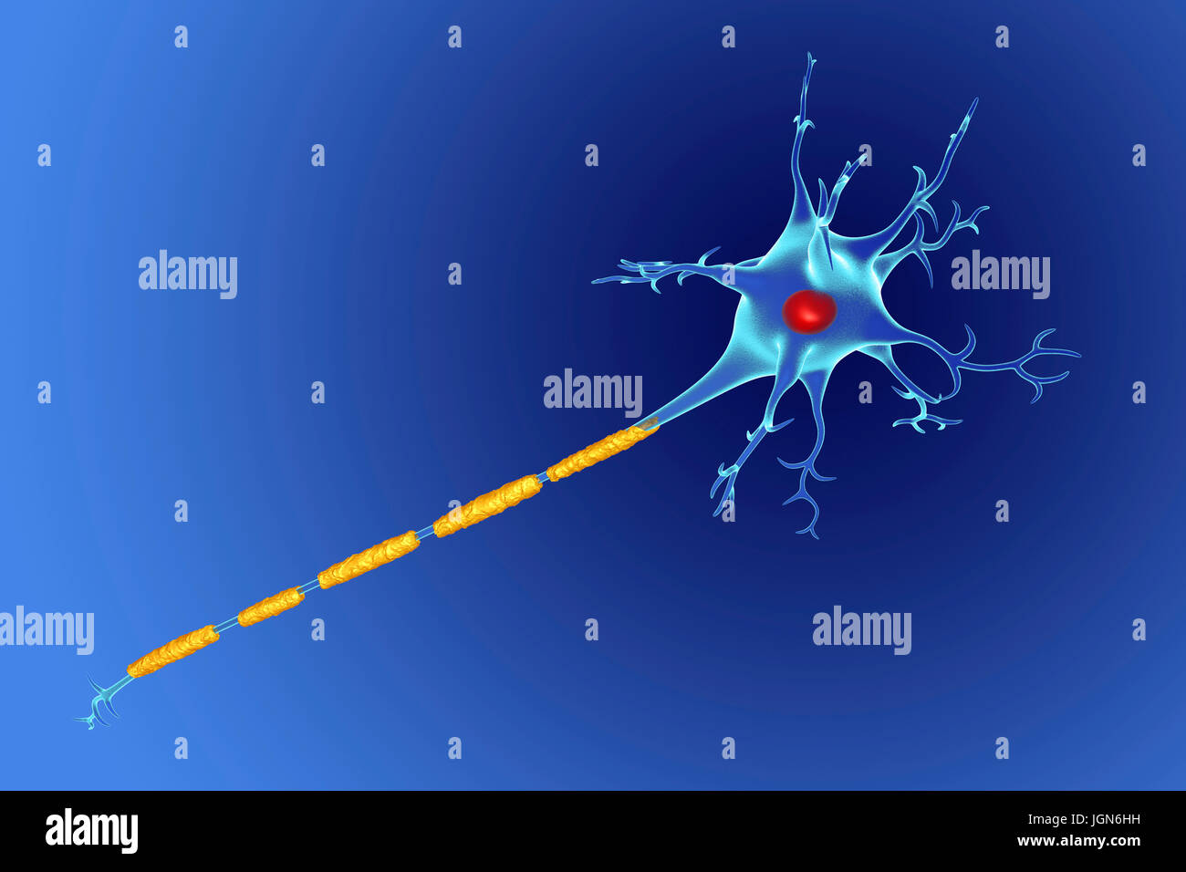Illustration of a nerve cell (neuron) with a damaged myelin sheath ...