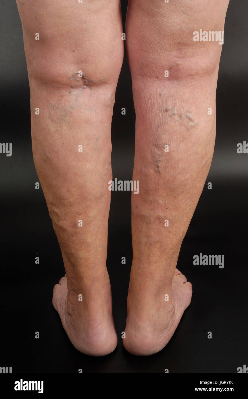 varicose veins in the leg of a woman Stock Photo - Alamy