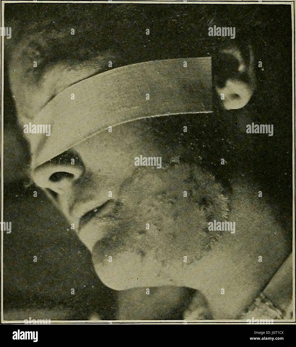 Syphilis historical hi-res stock photography and images - Alamy