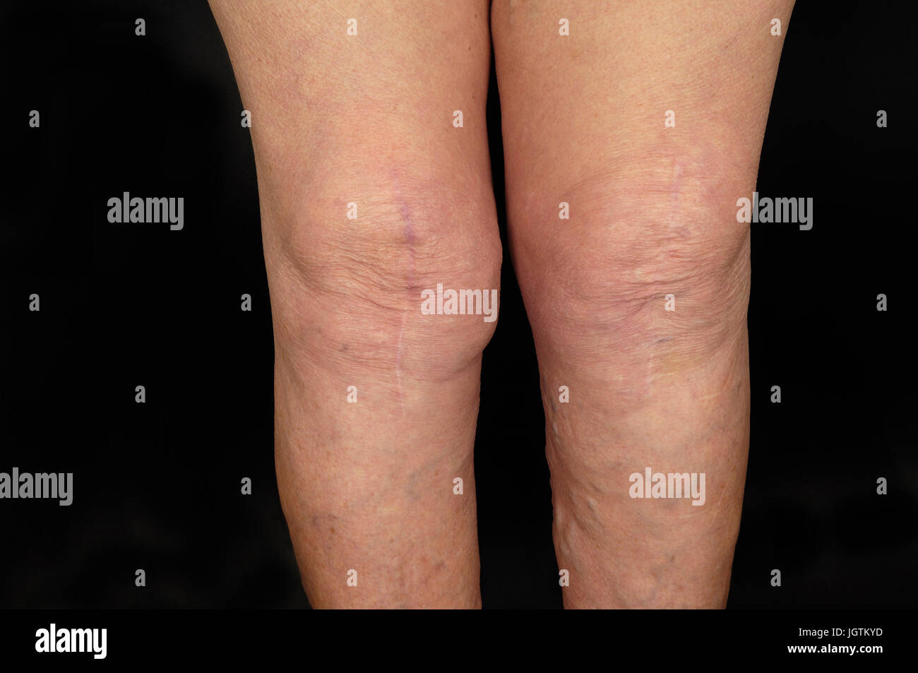 Knee surgery scar hi-res stock photography and images - Alamy