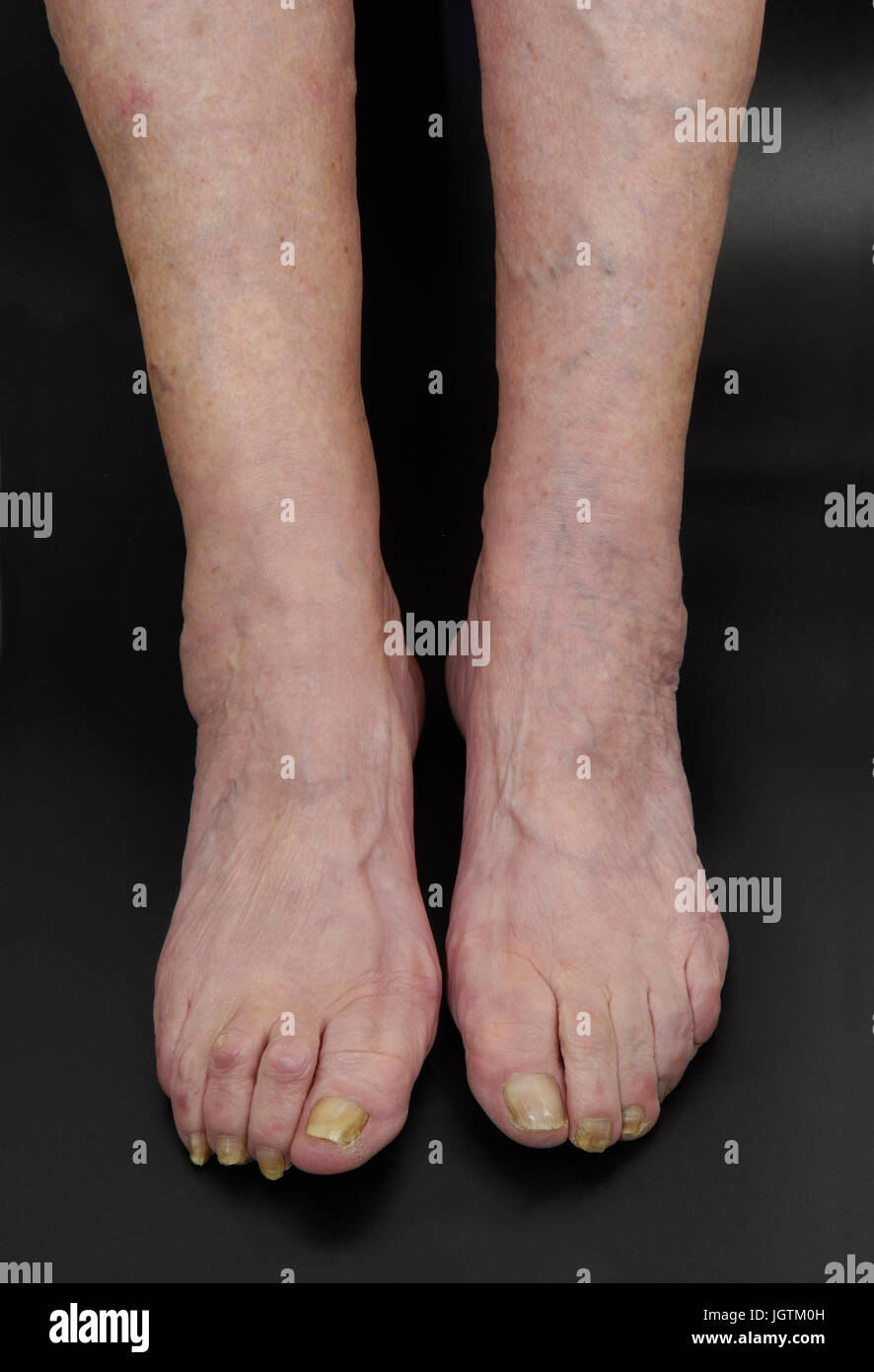leg and foot senior woman Stock Photo - Alamy