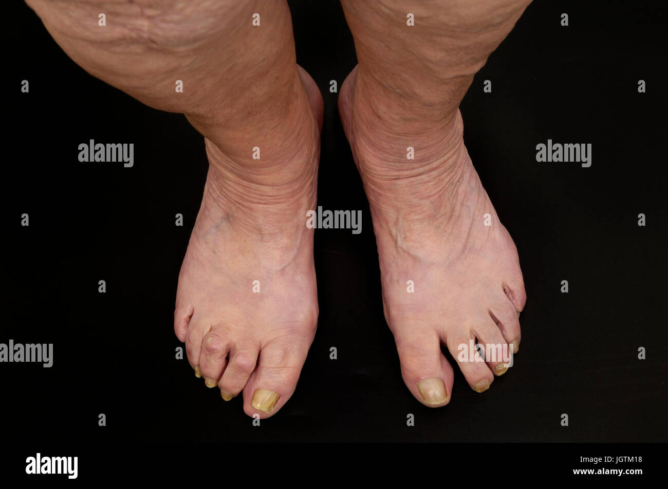 feet of a senior woman Stock Photo - Alamy
