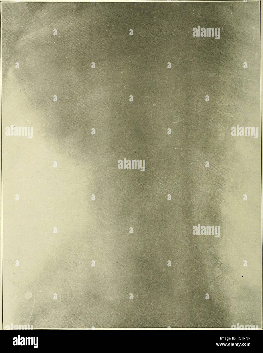Syphilis historical hi-res stock photography and images - Alamy