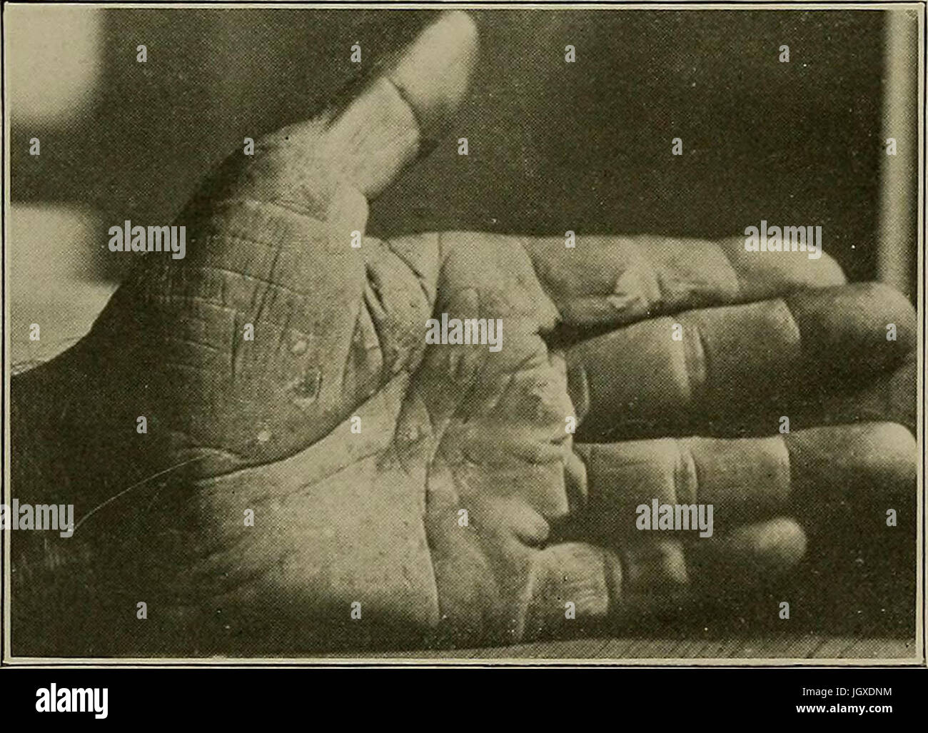 Old syphilis hi-res stock photography and images - Alamy