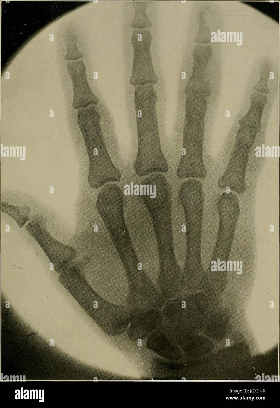 Old syphilis hi-res stock photography and images - Alamy