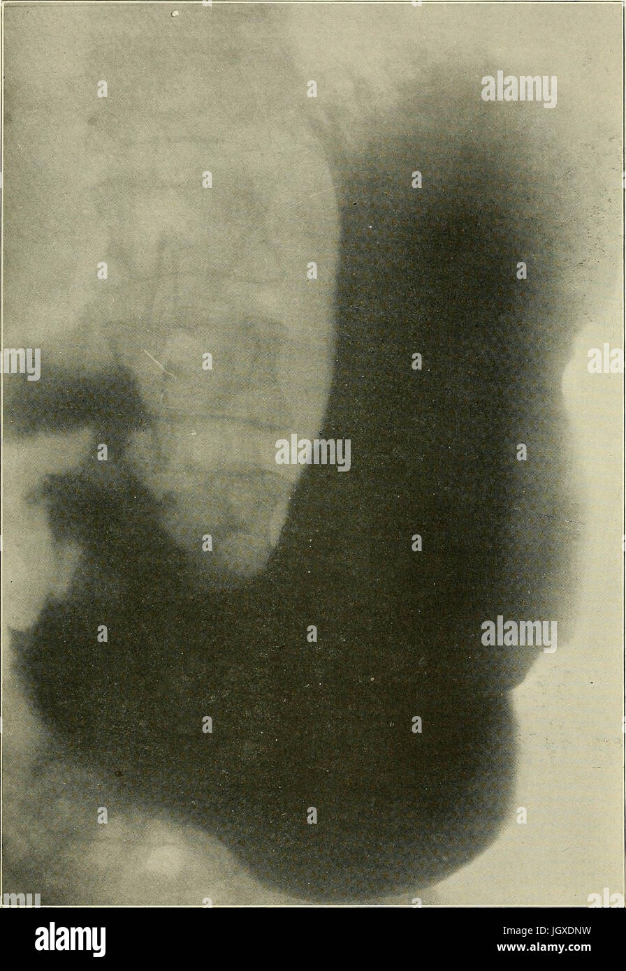 Old syphilis hi-res stock photography and images - Alamy