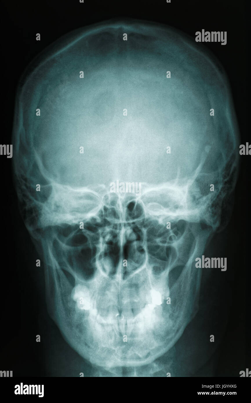 X-ray skull of woman as radiography film, medical concept, black ...