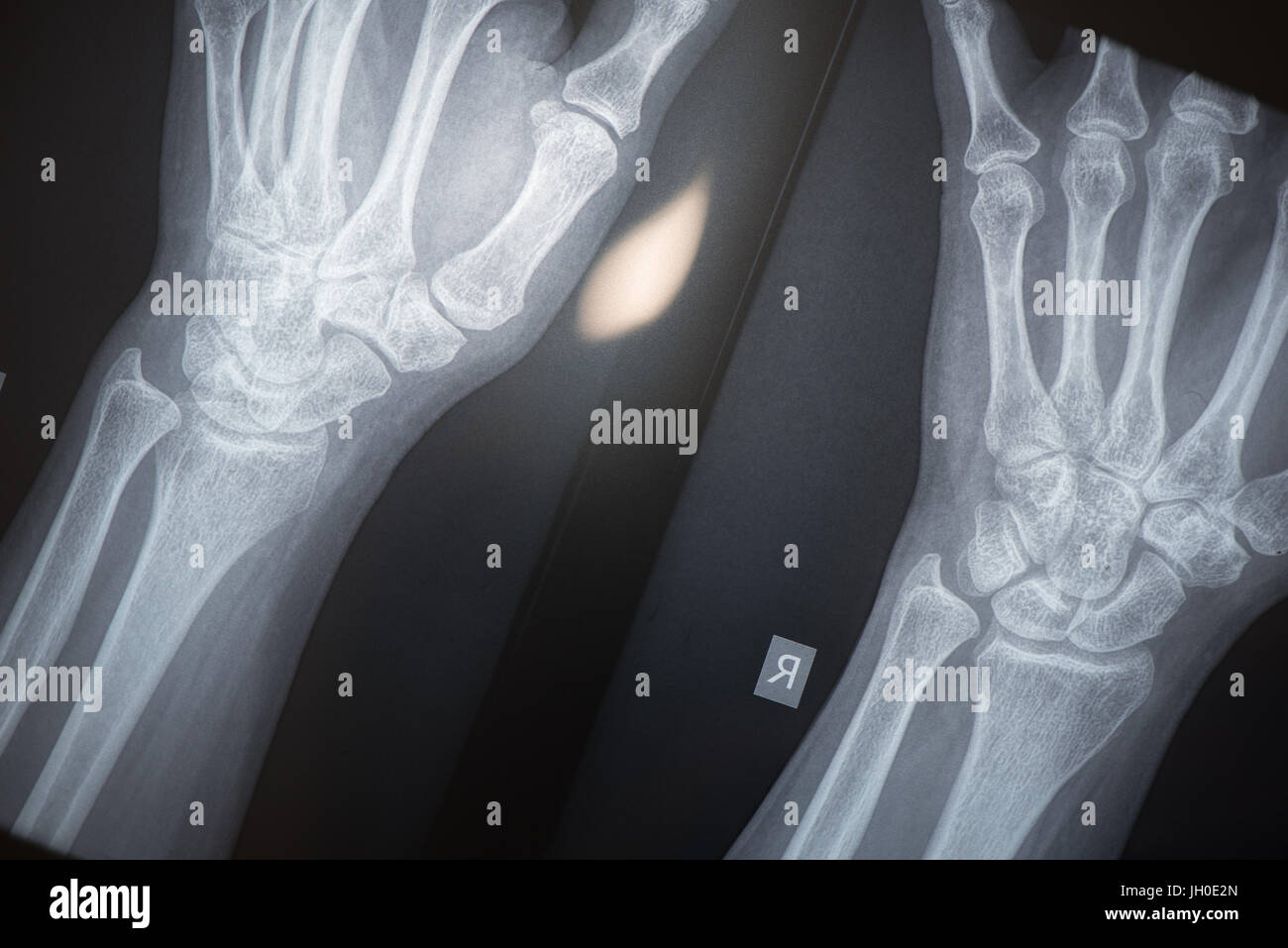 Xray image of right wrist bones Stock Photo - Alamy