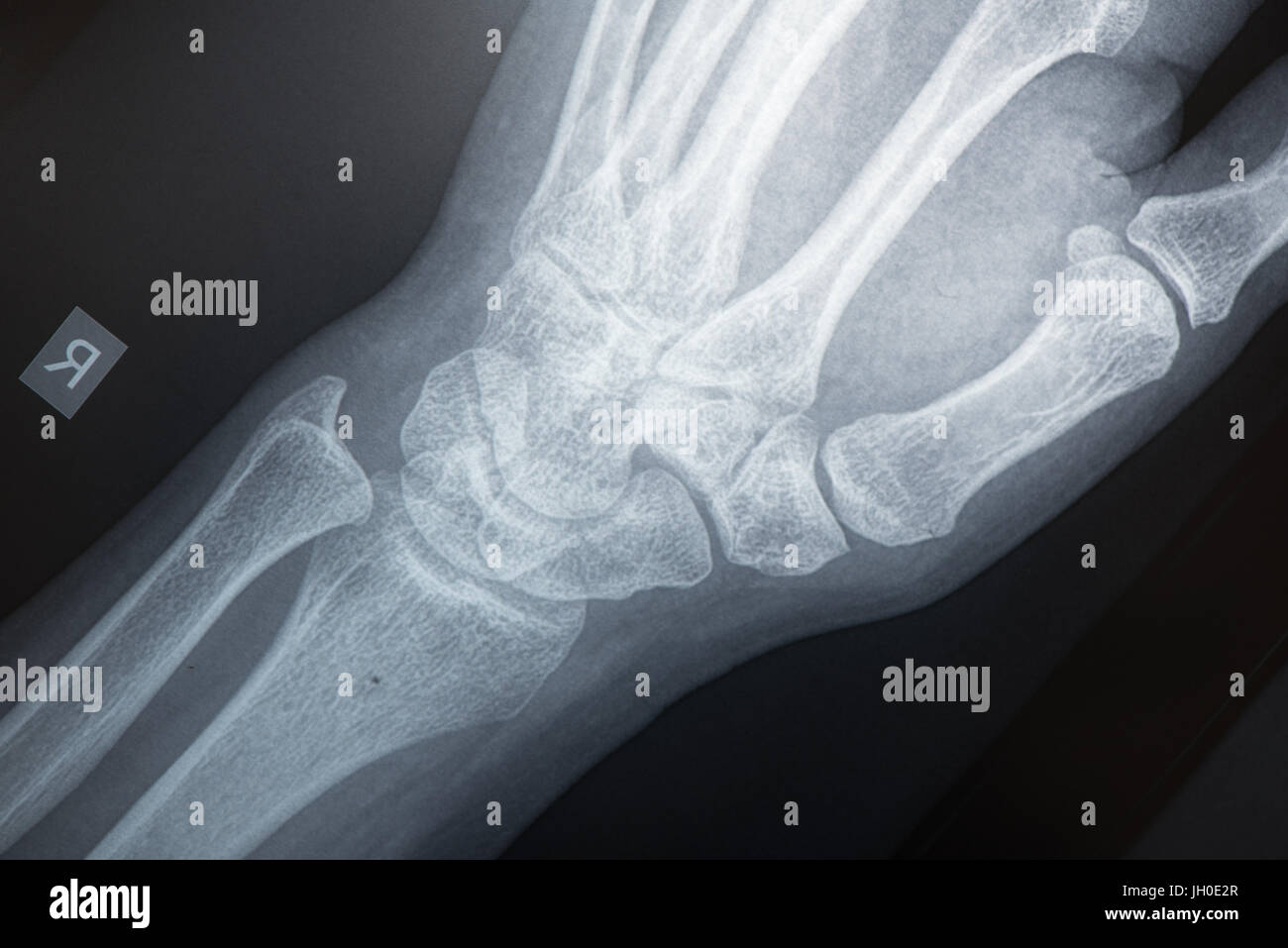 Xray image of right wrist bones Stock Photo - Alamy