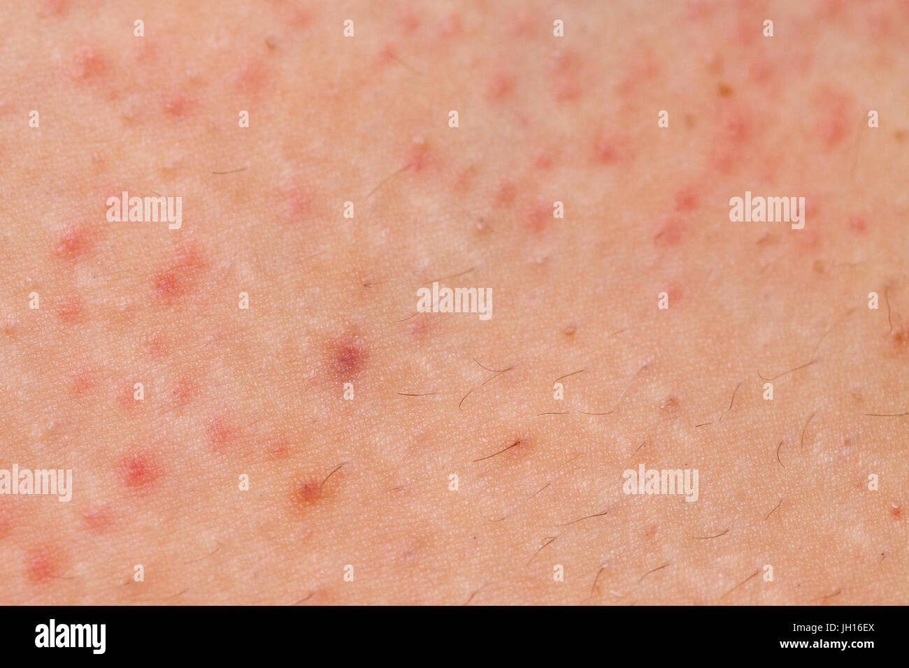 Folliculitis hi-res stock photography and images - Alamy