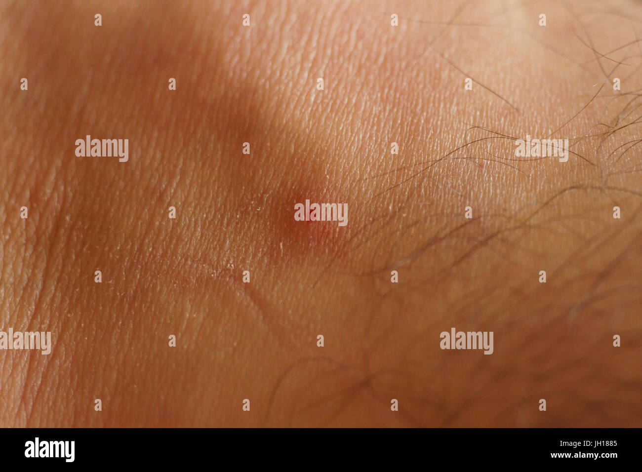 Black fly bite, skin, people, São Paulo, Brazil Stock Photo - Alamy