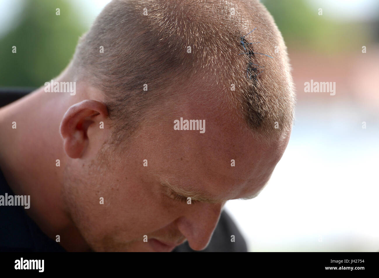 Nottinghamshire's Luke Fletcher shows his head injury during the press ...