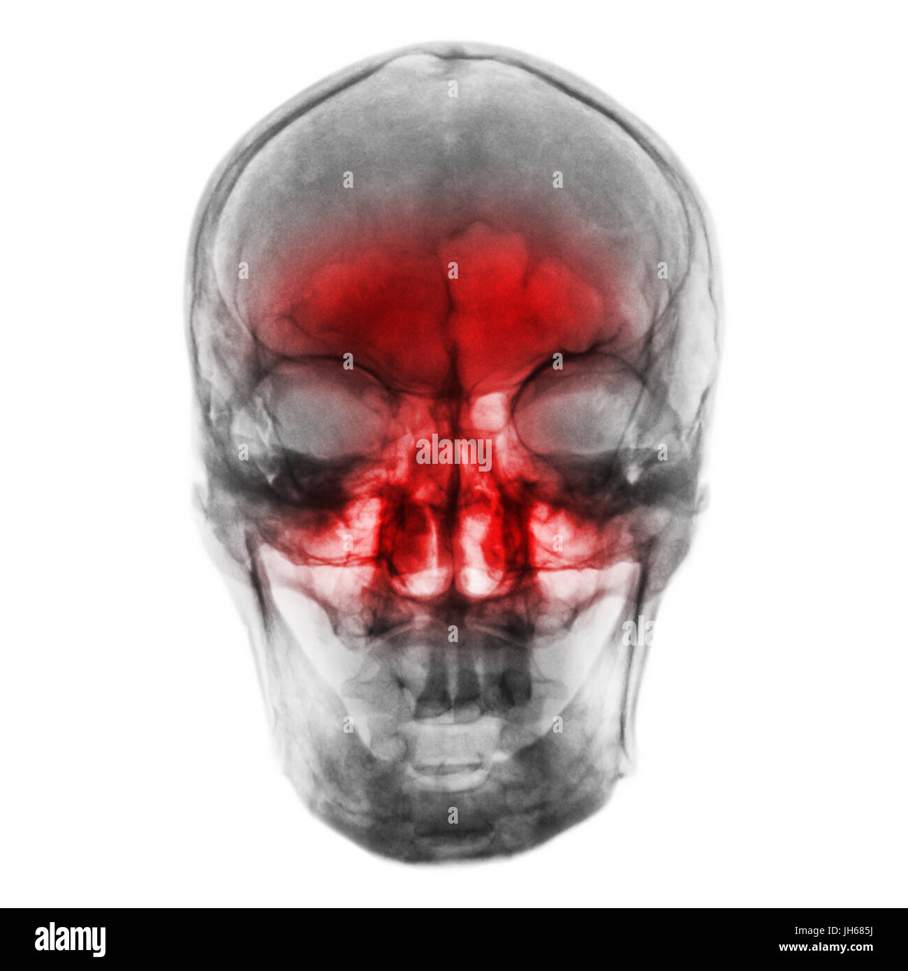 Sinuses Of The Skull