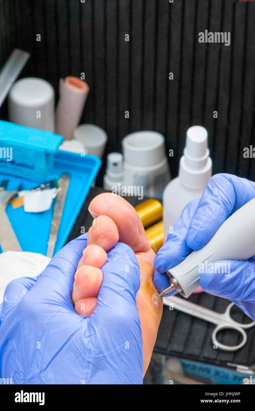 Hardened skin hi-res stock photography and images - Alamy