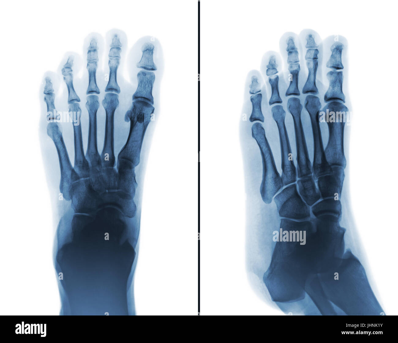 Film x-ray both normal human foots . 2 position ( front view and side ...