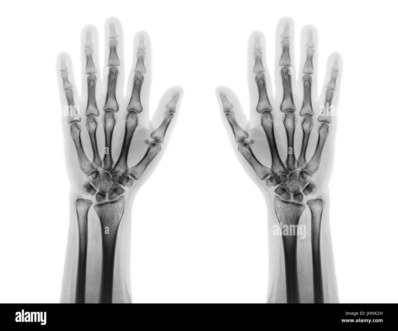 Human wrist anatomy xray view Cut Out Stock Images & Pictures - Alamy