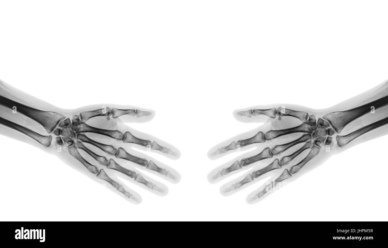 Shake hands . X-ray normal human hands ( blank area at upper side Stock ...
