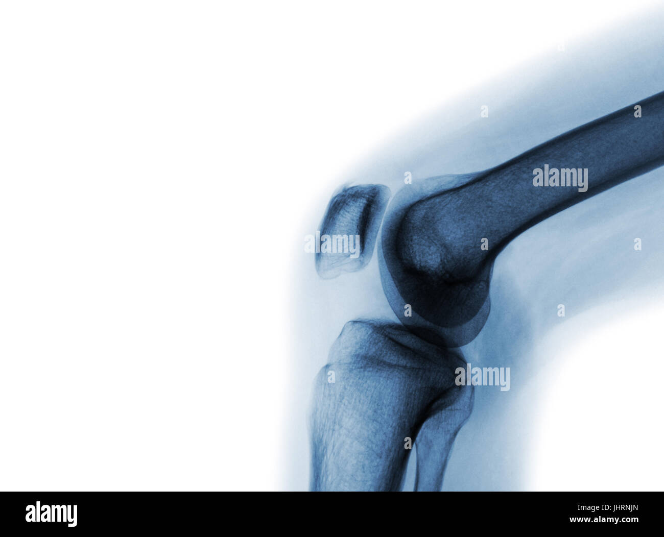 Film x-ray of normal knee joint and blank area at left side Stock Photo ...
