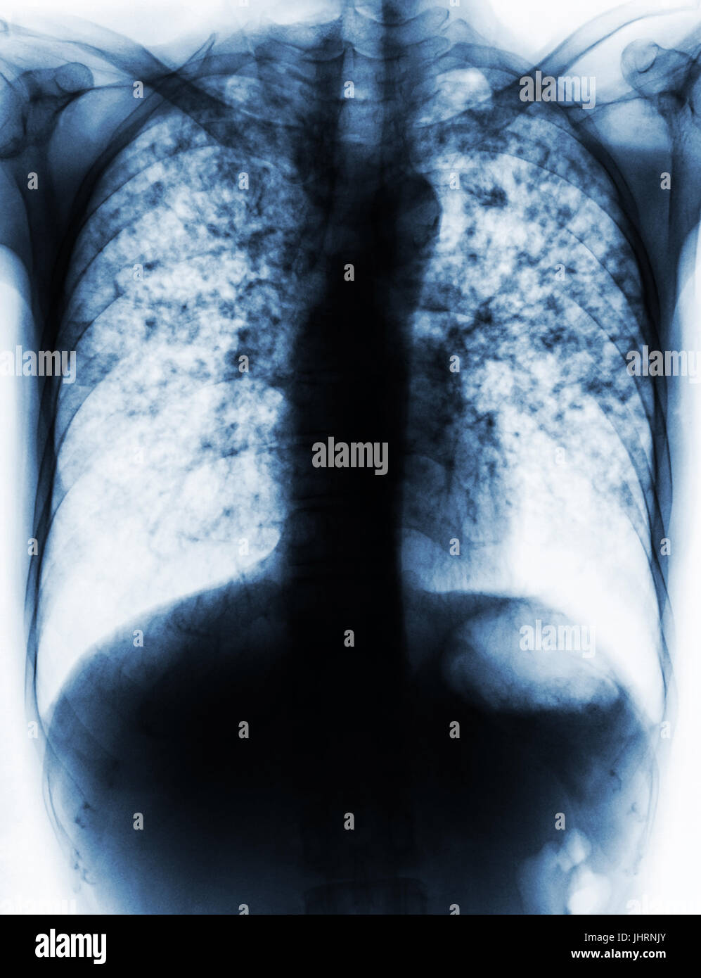 Pulmonary Tuberculosis . Film chest x-ray show fibrosis , interstitial ...