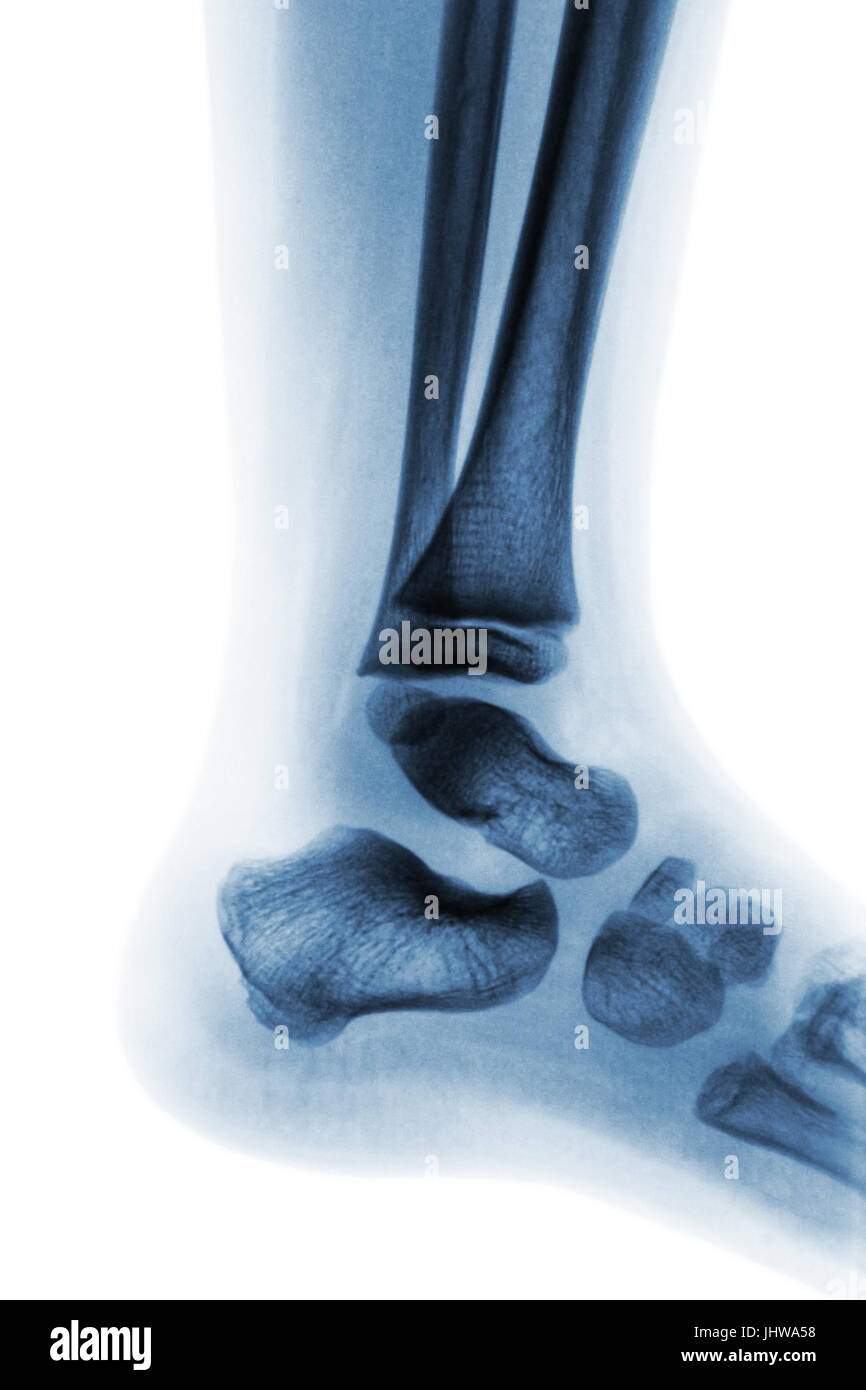 Film x-ray of normal child ankle . Lateral view Stock Photo - Alamy